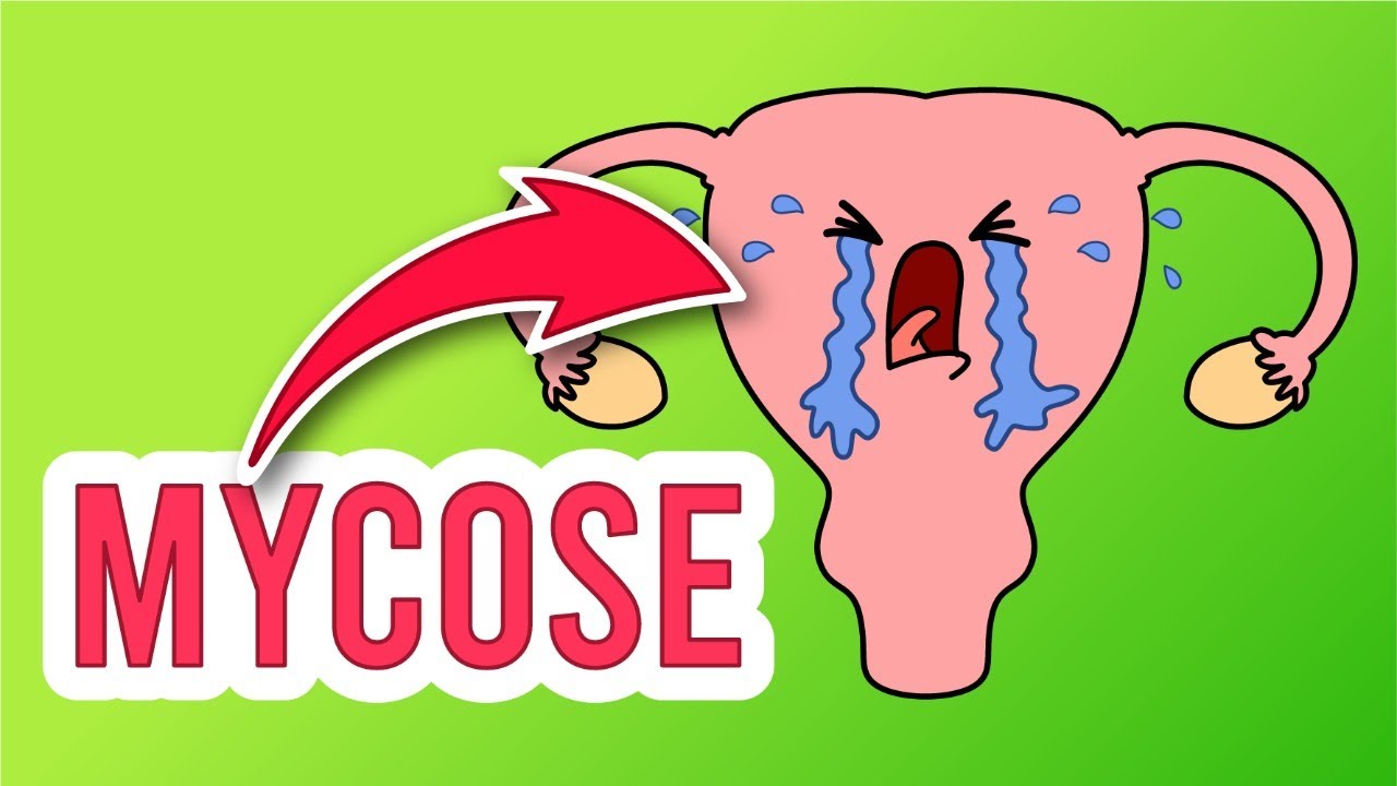 Mycose vaginale : voici comment se soigner naturellement - YouTube