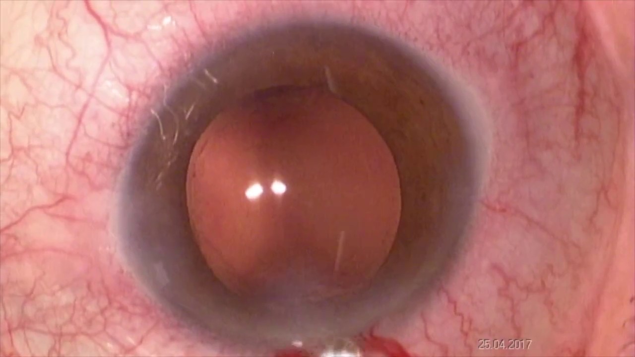 One Step Implantation der preloaded IOL HOYA Vivinex (XY1) - YouTube