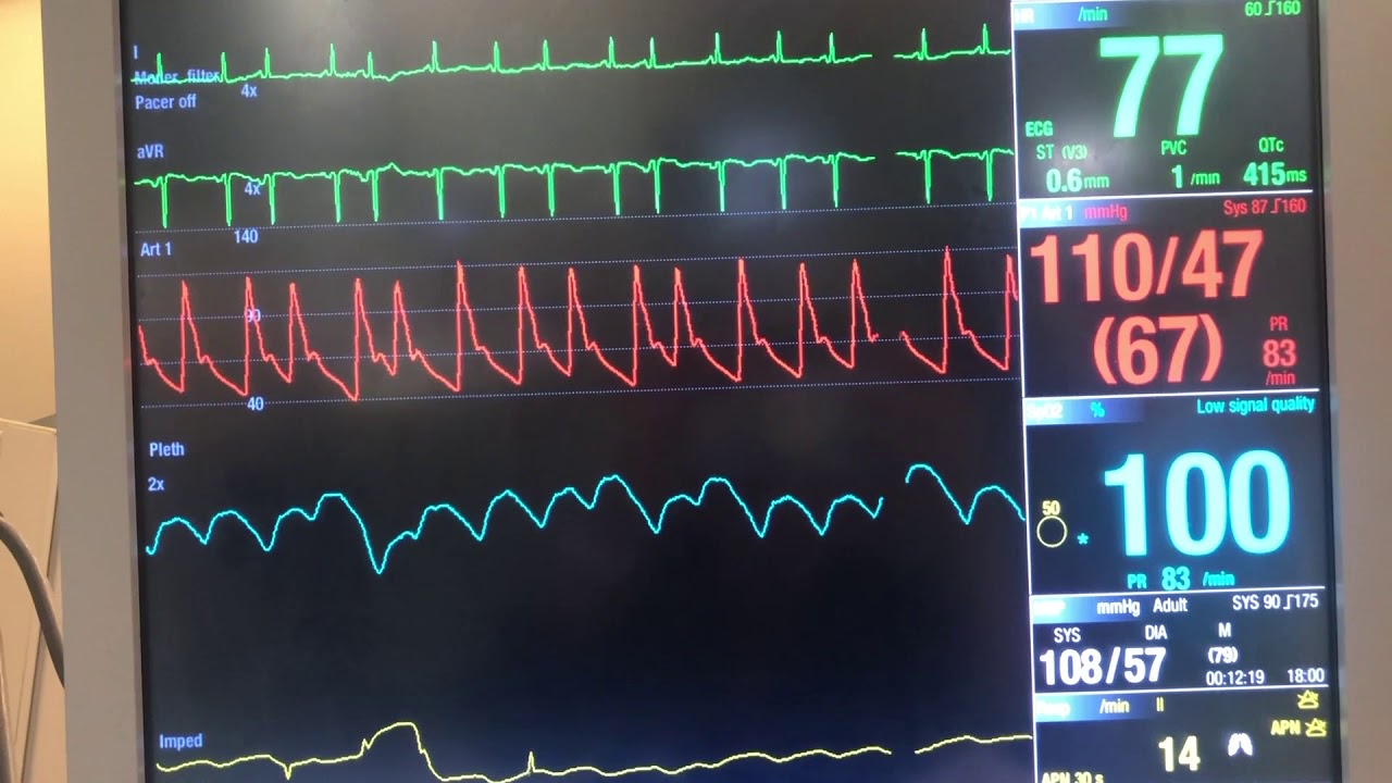 Arterial Line Waveform in Atrial Fibrillation - YouTube