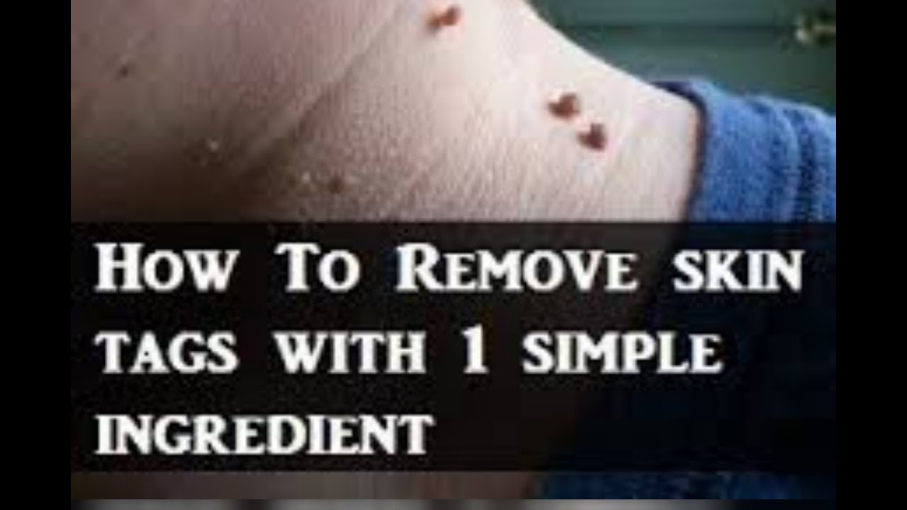 How to remove skin tag naturally/Get rid of skin tags fast - YouTube