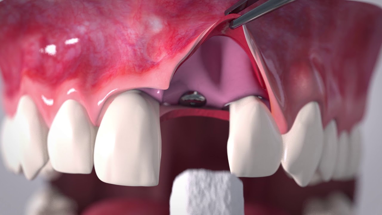 Soft Tissue Thickening with Geistlich Fibro Gide® - YouTube