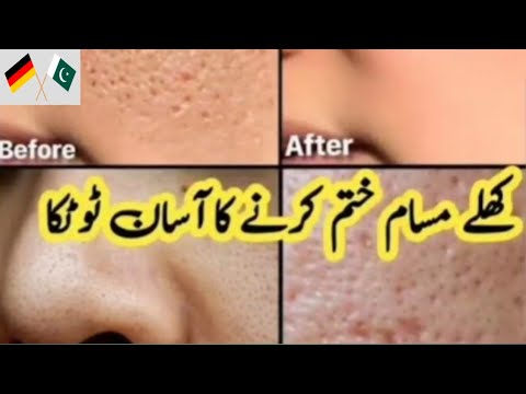 How to Get Rid of open pores permanently#/pakistani mam Germany. - YouTube
