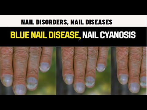 Blue Nails Disease| Nail Cyanosis - YouTube