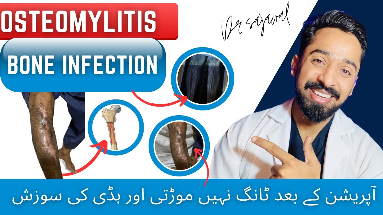Osteomyelitis _ Bone Infection | Haddi ka Infection | Bone Infection ...