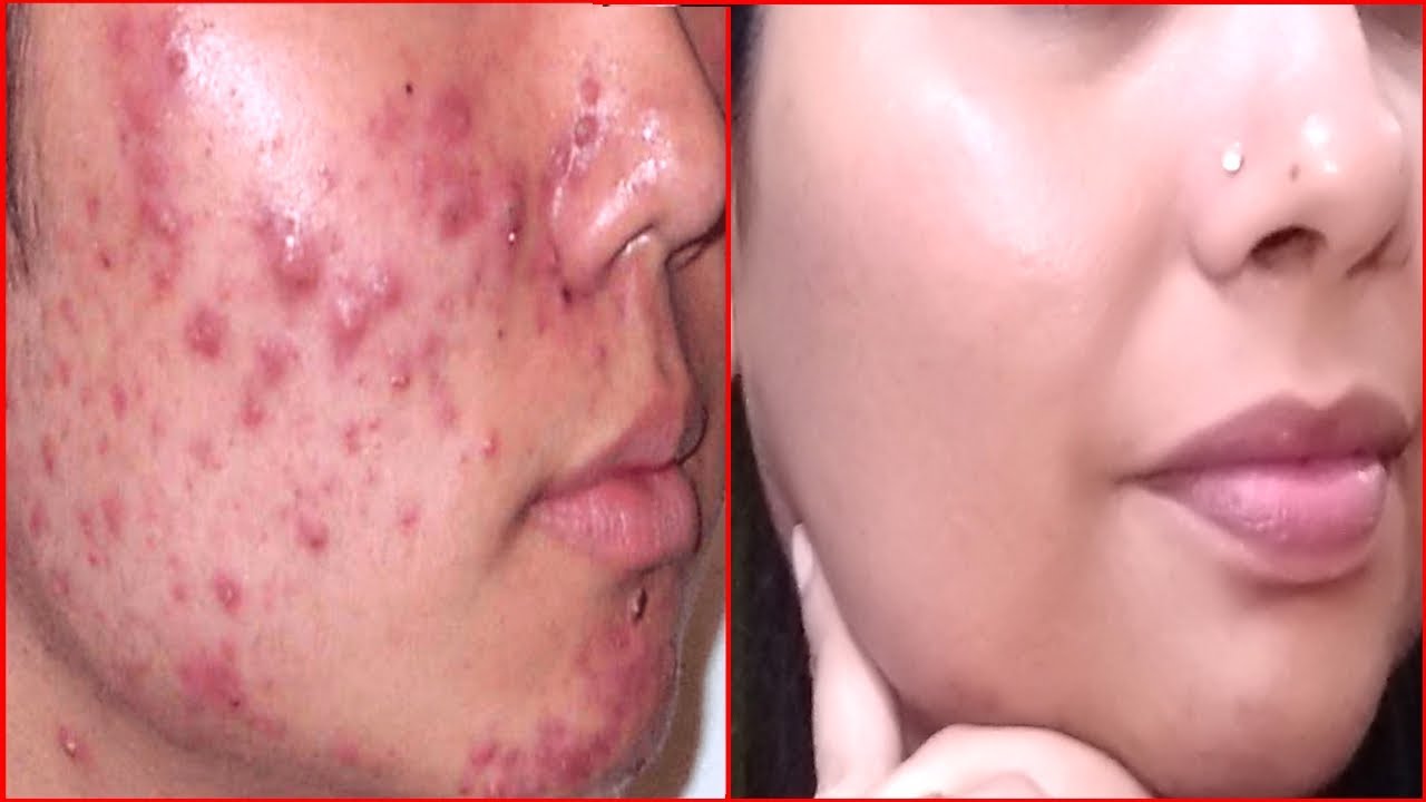 How To Remove Pimples Overnight Acne Treatment Simple Style Tips