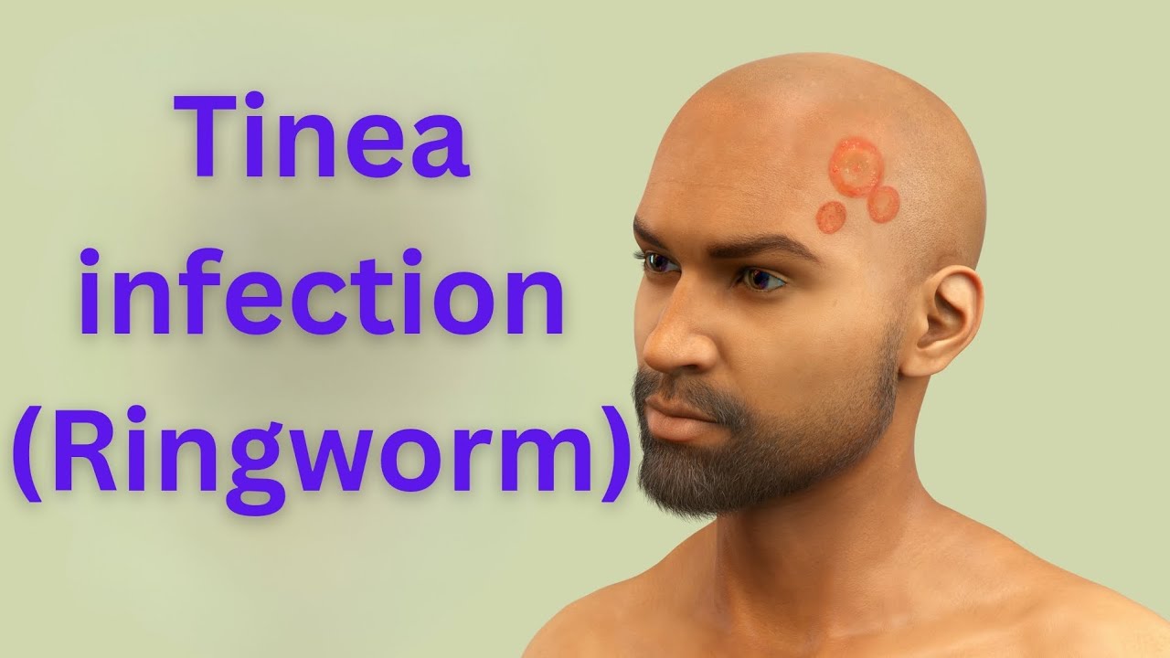 Tinea Infection: Clinical Types and Classical Presentations - YouTube
