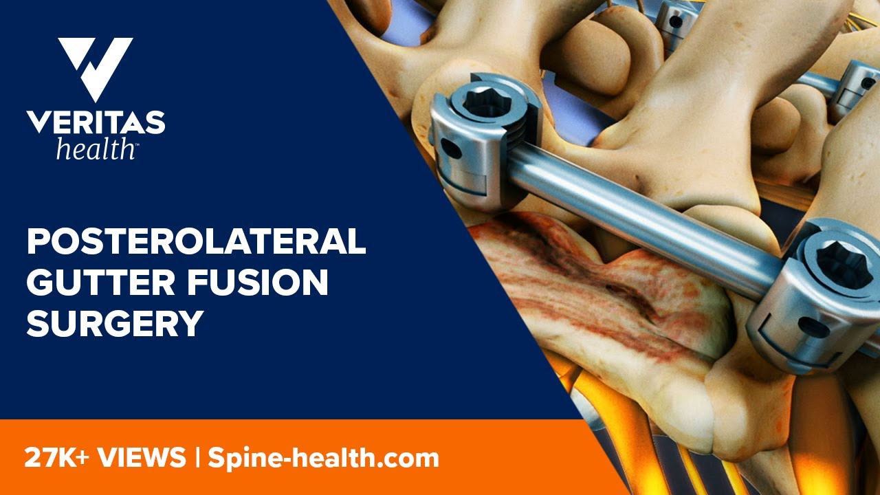 Posterolateral Gutter Fusion Surgery - YouTube