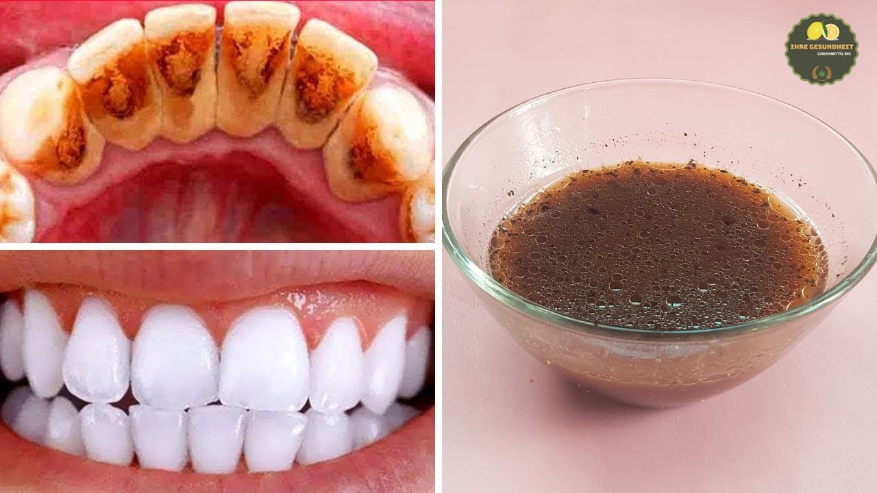 Verwenden Sie einfach diese 2 Zutaten, um ihren Zahnstein nach 3 ...