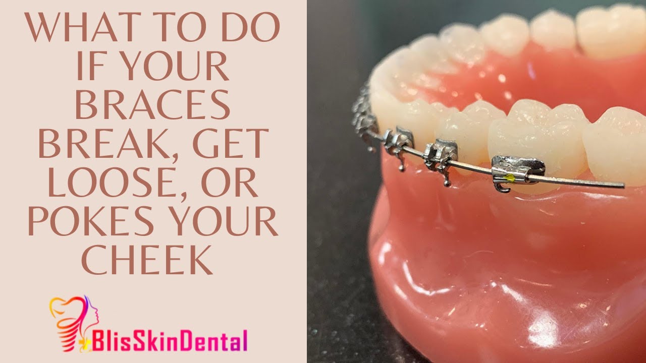 What to do if your Braces Break, Get Loose, or Pokes your cheek ...