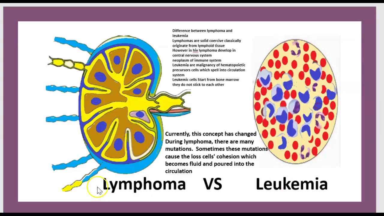 Hodgkins & Non-Hodgkins Classification Staging Type Lymphoma Reed ...