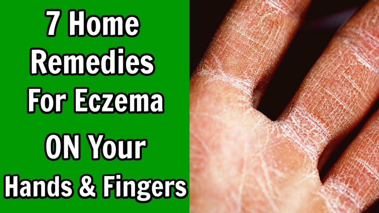 7 Home Remedies For Eczema On Hands And Fingers Youtube
