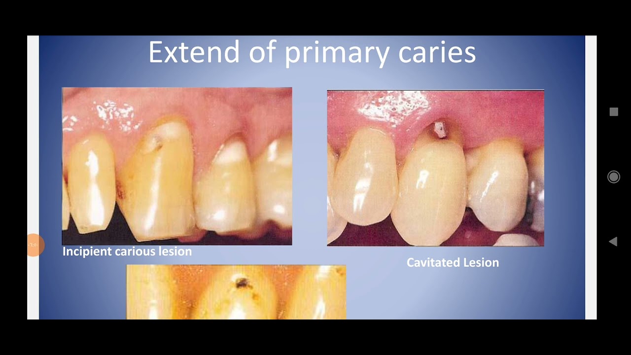شرح carious and non carious lesions - YouTube