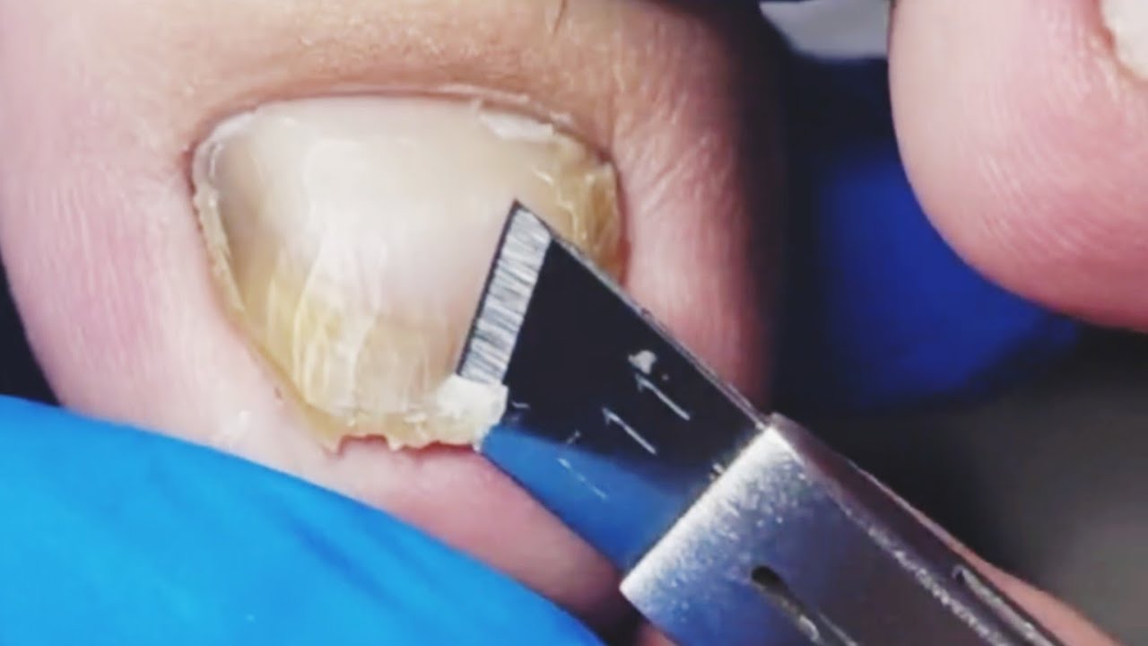 Too stubborn nail pedicure (no1 manicure) - YouTube