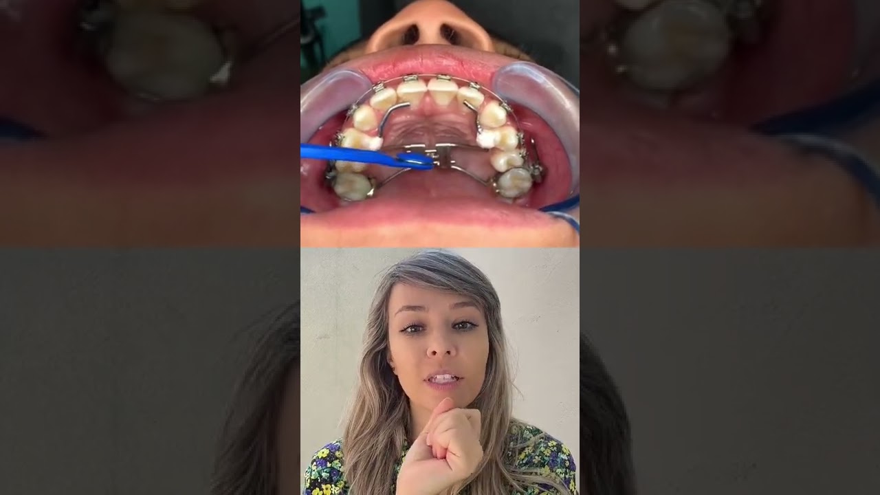 DISJUNCTOR | APARAT DENTAR - YouTube