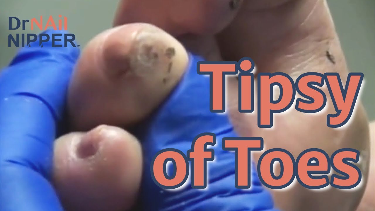 Tipsy Toe Callus. Throwback - YouTube