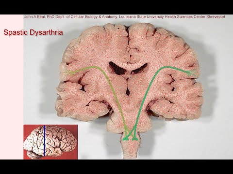 Spastic dysarthria - samples and tutorial
