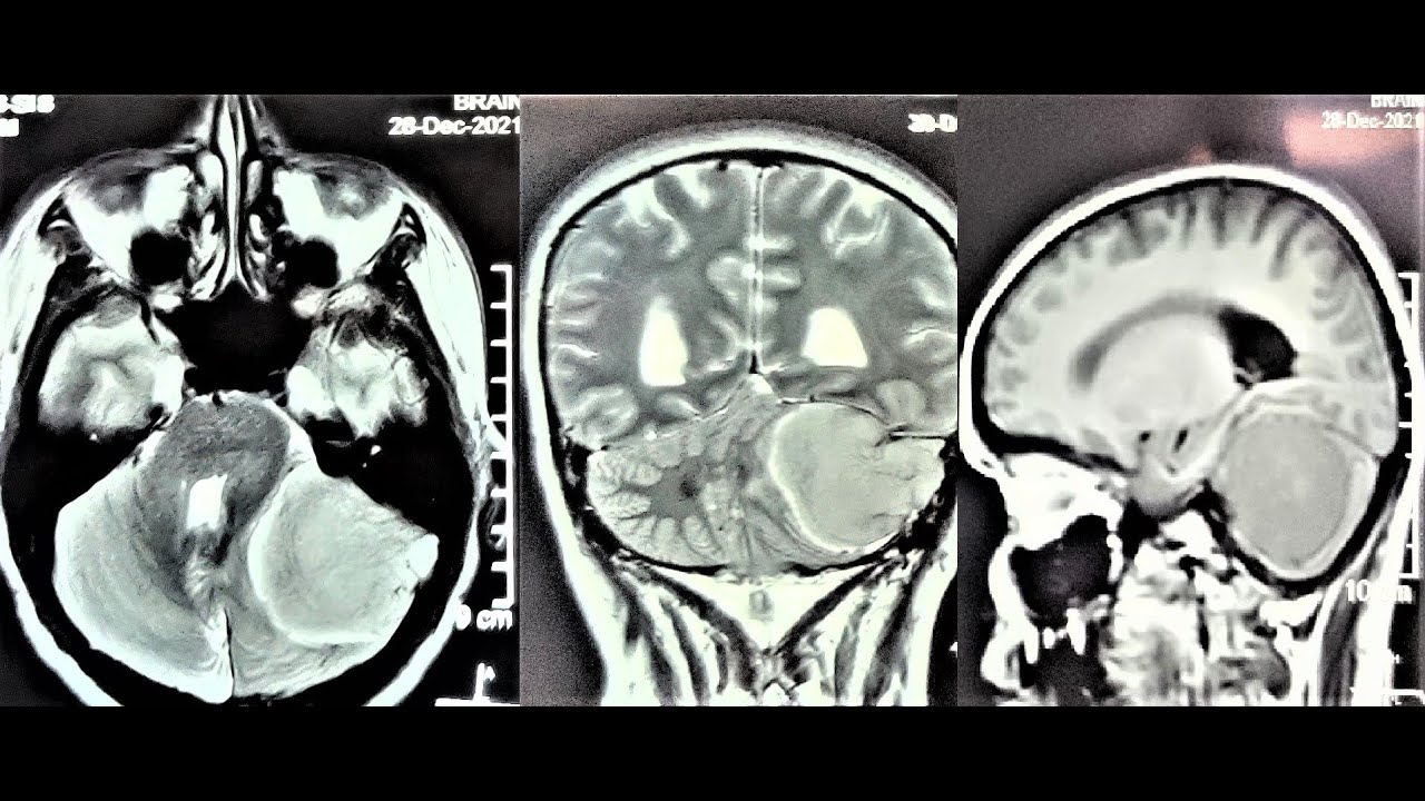 LARGE TENTORIAL/CEREBELLO-PONTINE ANGLE MENINGIOMA-MICROSURGERY-dr ...