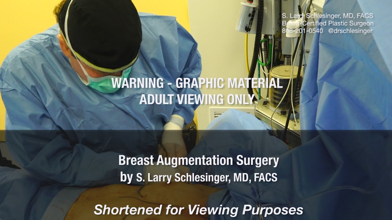 Breast Implants Using a Transaxillary (Armpit) Incision - Dr. S. Larry ...