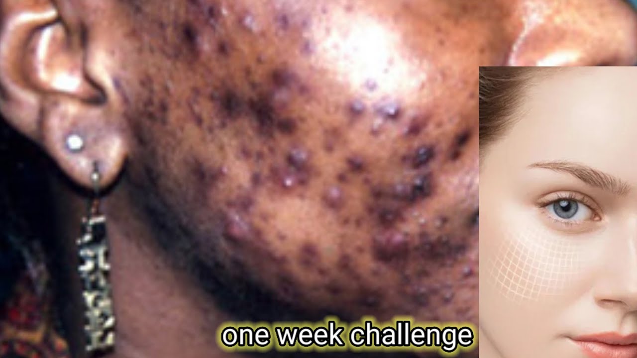one week challenge pimple,acne treatment at home||remove big pimple ...