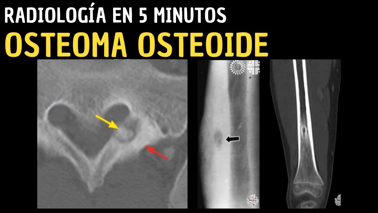 Radiología en 5 minutos: Osteoma osteoide. - YouTube