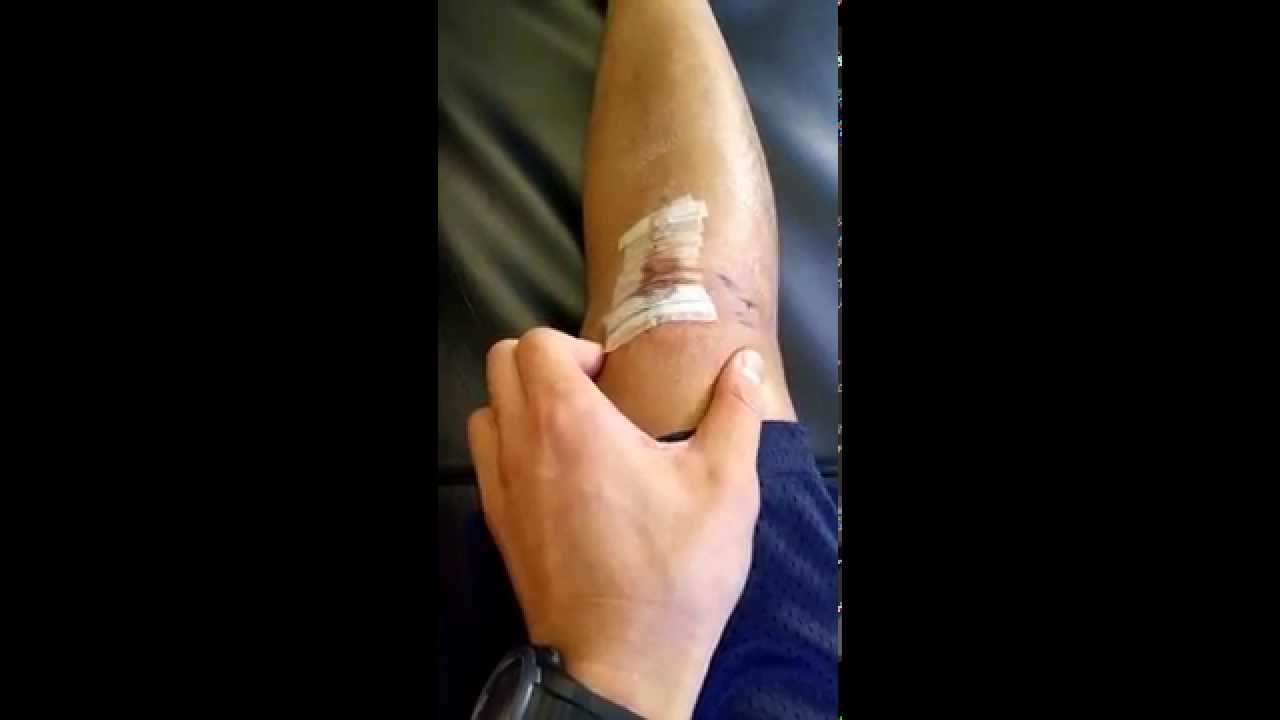 ACL Recovery Day 13: Patella Mobilization - YouTube
