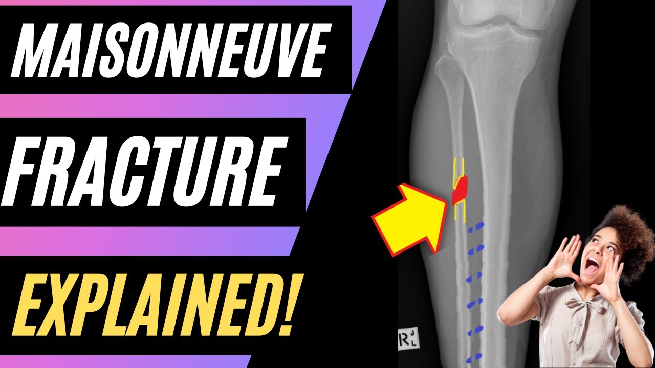 What is a MAISONNEUVE FRACTURE? - YouTube