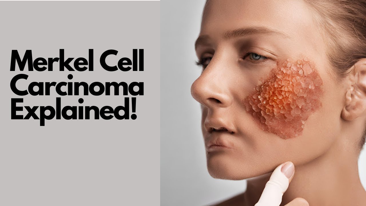 EDUCATIONAL VIDEO | Merkel Cell Carcinoma Wikipedia Audio Article ...