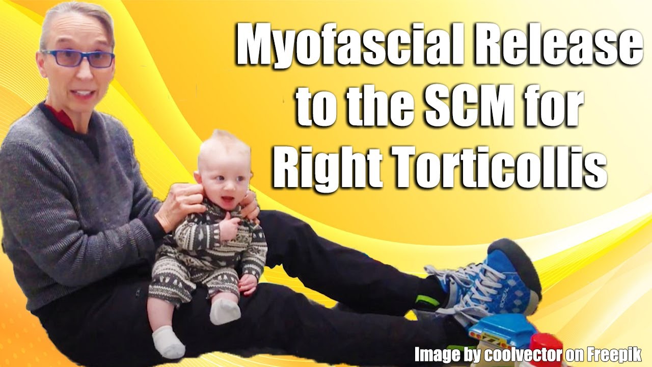 Gentle Sternocleidomastoid Myofascial Release: Right-Sided Torticollis ...