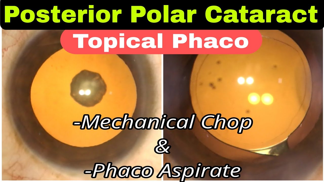 #166 How to conquer Posterior Polar Cataract(PPC)| Mechanical Chop ...