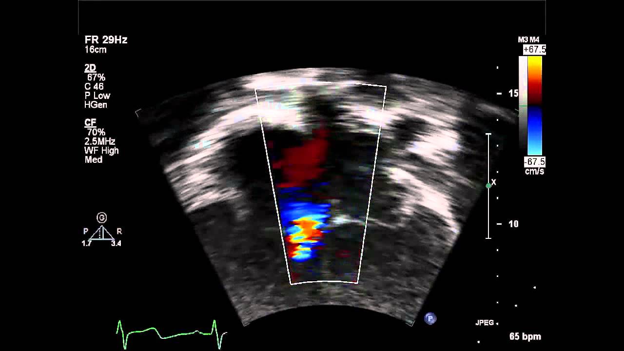 Secundum ASD A4C Color Doppler PV Drains Across Septum - YouTube