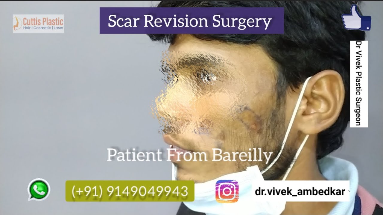 Scar Revision Surgery | Scar Removal Surgery | Face Scar #scar - YouTube