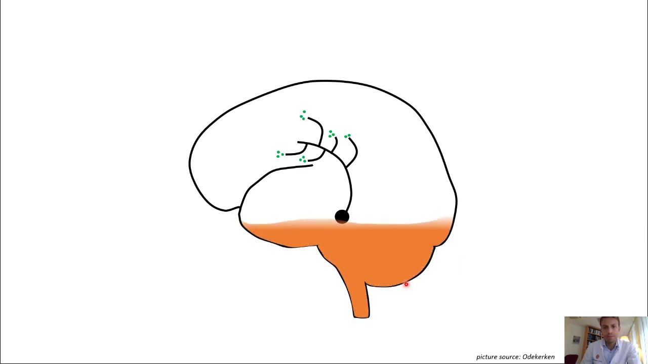 Parkinson's Disease (2/3): Pathophysiology of PD - YouTube
