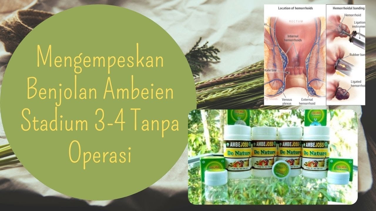#AMBEIEN Mengempeskan Benjolan Ambeien Stadium 3 4 Tanpa Operasi - YouTube