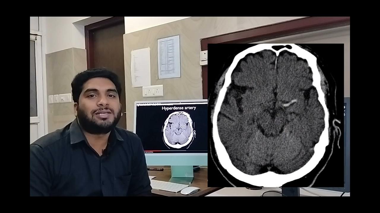 episode 10 HYPERDENSE MCA SIGN ????????? - YouTube