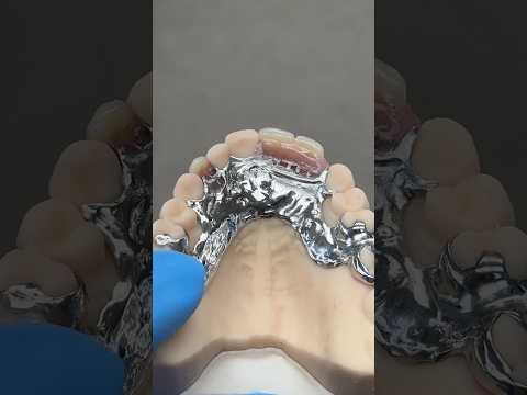 What Chrome Cobalt Dentures Look Like