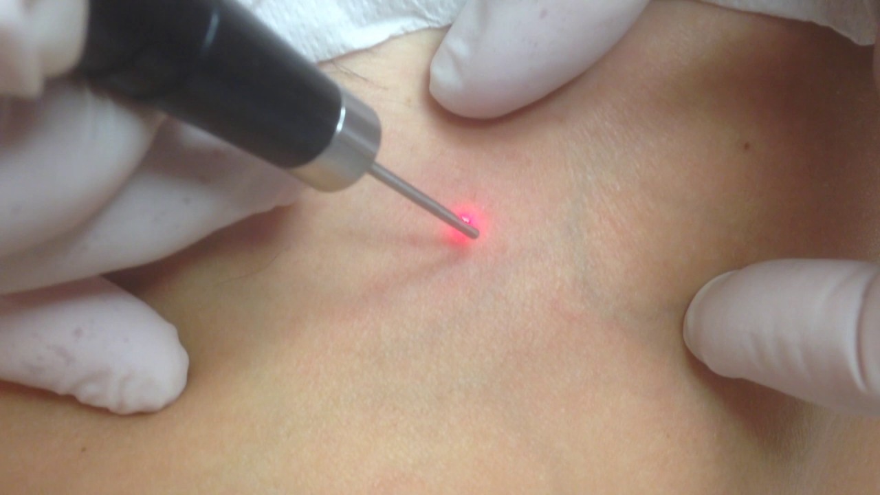 Eliminare i Dermatofibromi con il Laser Frazionato - YouTube