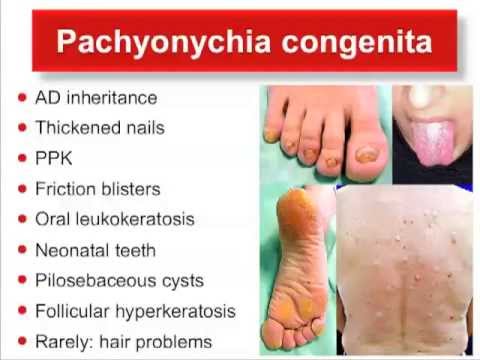 Inherited Nail Disorders presentation by Prof. Eli Sprecher at ...