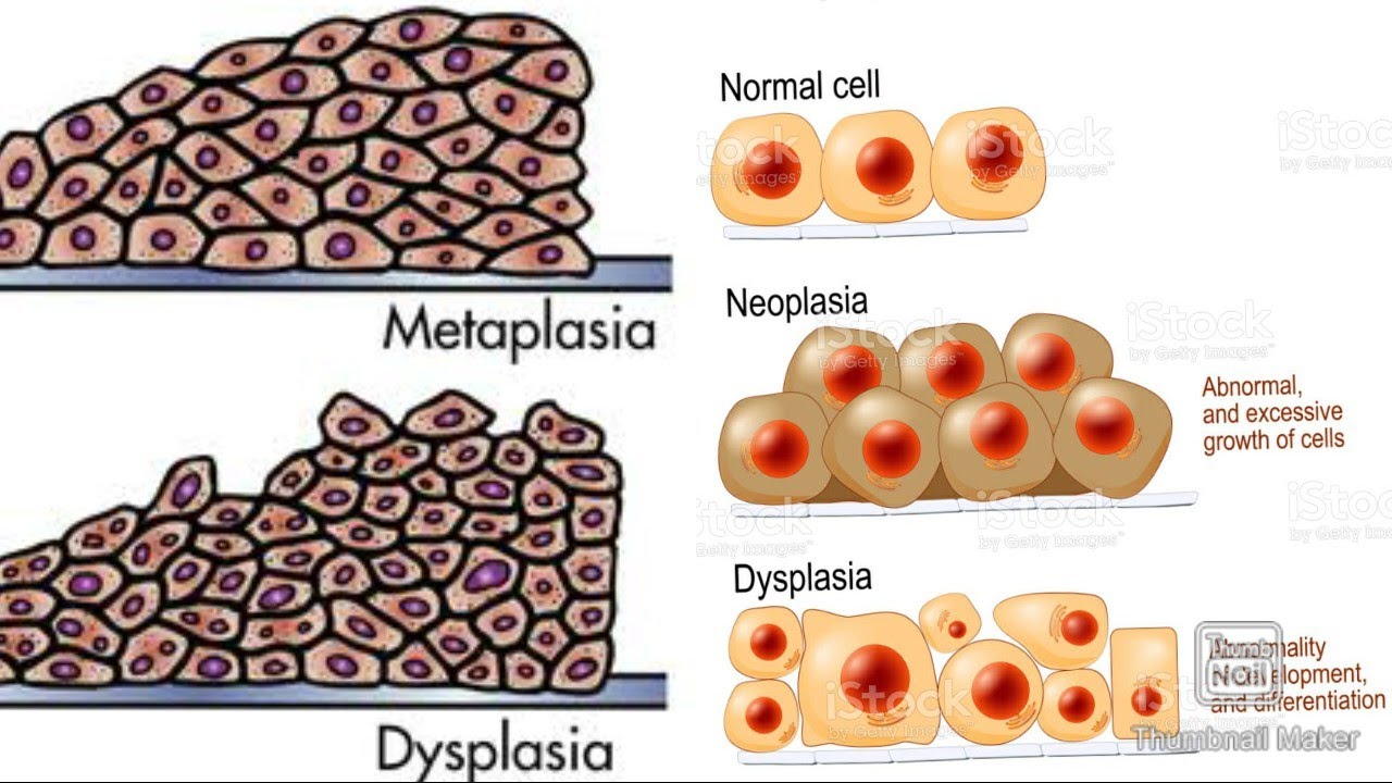 Metaplasia and dysplasia 😀 - YouTube