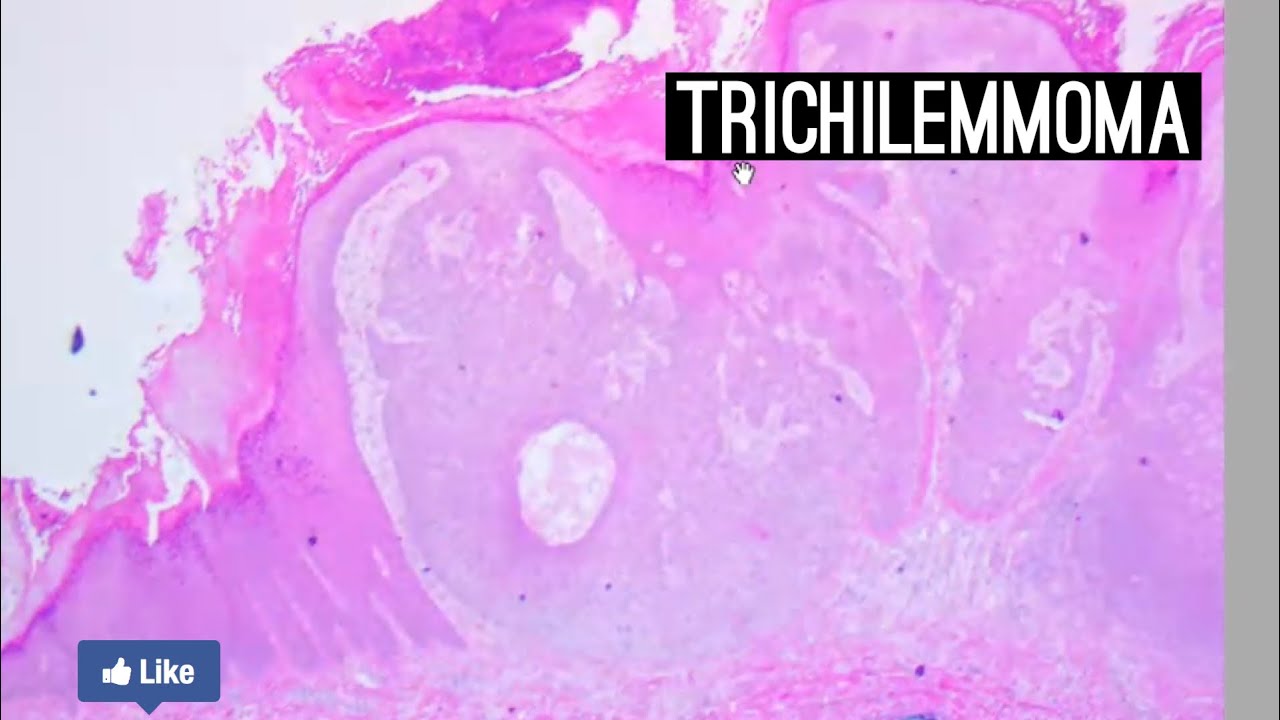 Trichilemmoma - YouTube