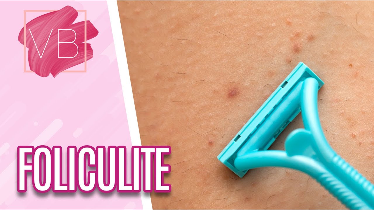 Foliculite: o que é e como tratar corretamente - Você Bonita (25/01 ...