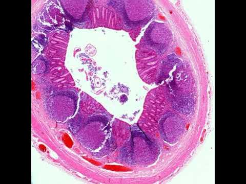 Pinworms in the Appendix (Enterobiasis) #shorts #pathology # ...
