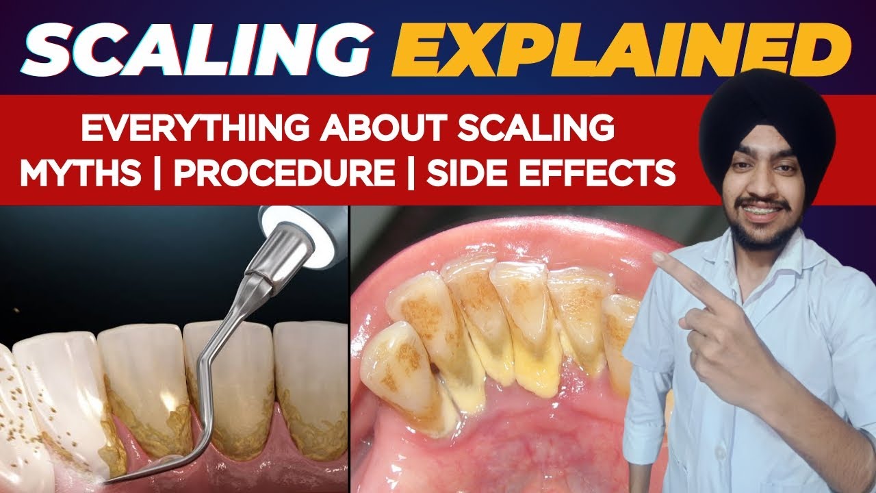 Dental Plaque और Calculus को जड़ से हटाएं | Permanent Solution for ...