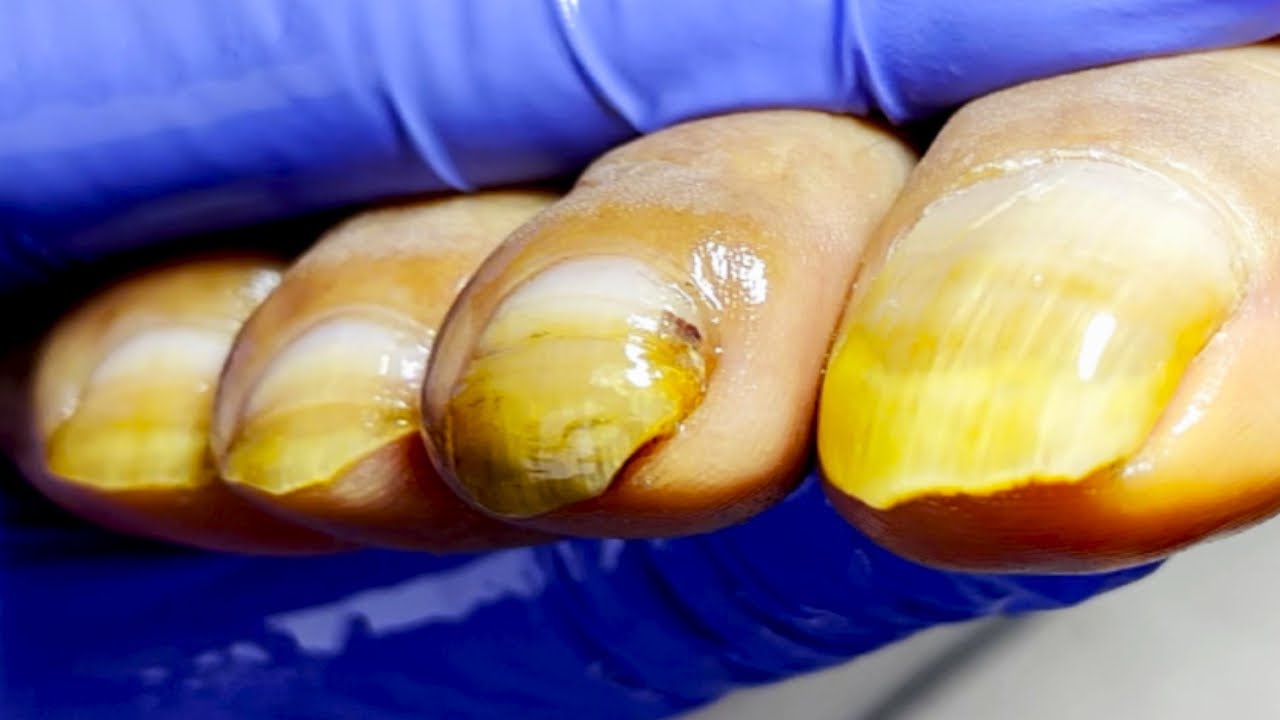 Easily Trim Toenails For A Professional Pedicure【Podiatry Clinic】 - YouTube