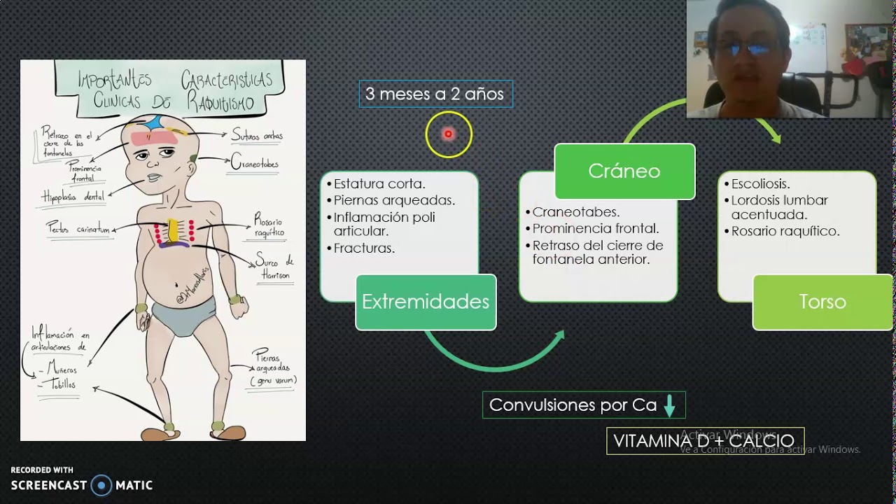 Raquitismo - YouTube