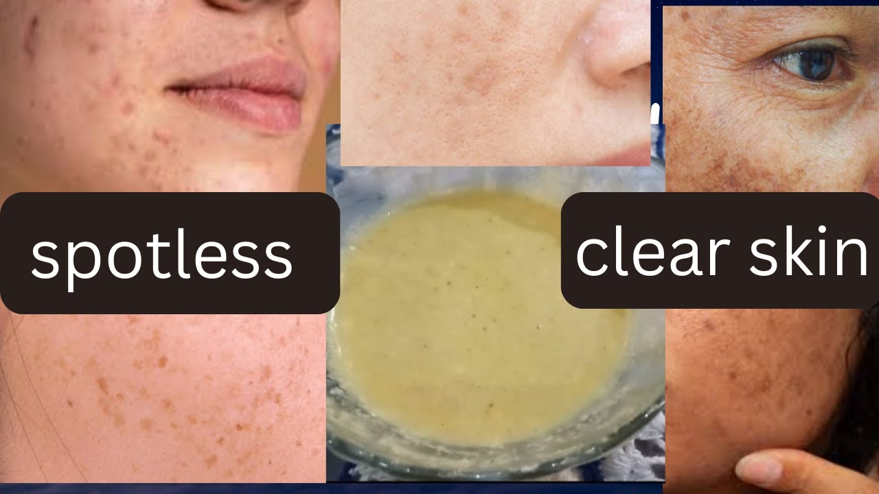 Spotless clear skin challenge hyperpigmentation cure remedy by Nishat ...