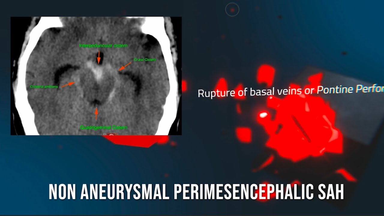 Non Aneurysmal Perimesencephalic haemorrhage, lets diagnose it ...