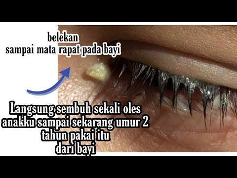Pengalaman mengatasi sakit mata belekan belek pada bayi ampuh langsung sembuh