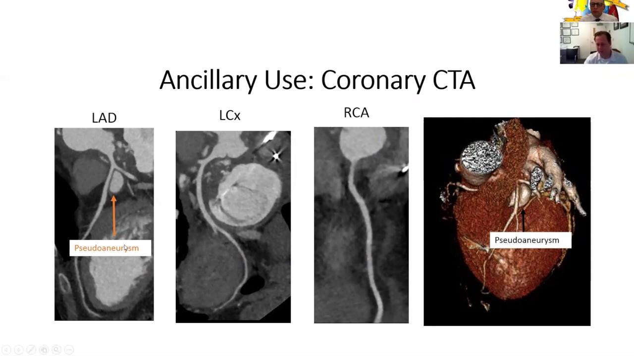 Role of Cardiac CT in Endocarditis - YouTube