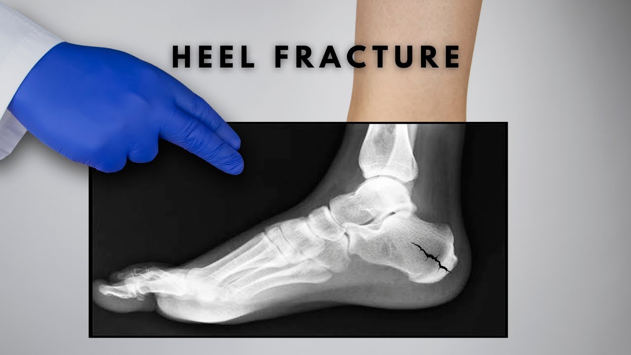 Understanding Stress Fractures of the Heel Bone: Causes, Symptoms, and ...