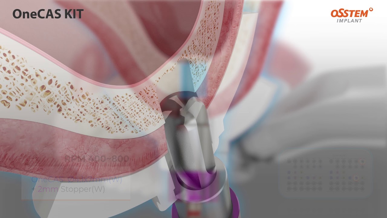 OneCAS KIT: OneGuide System for Sinus Lift Surgery - YouTube